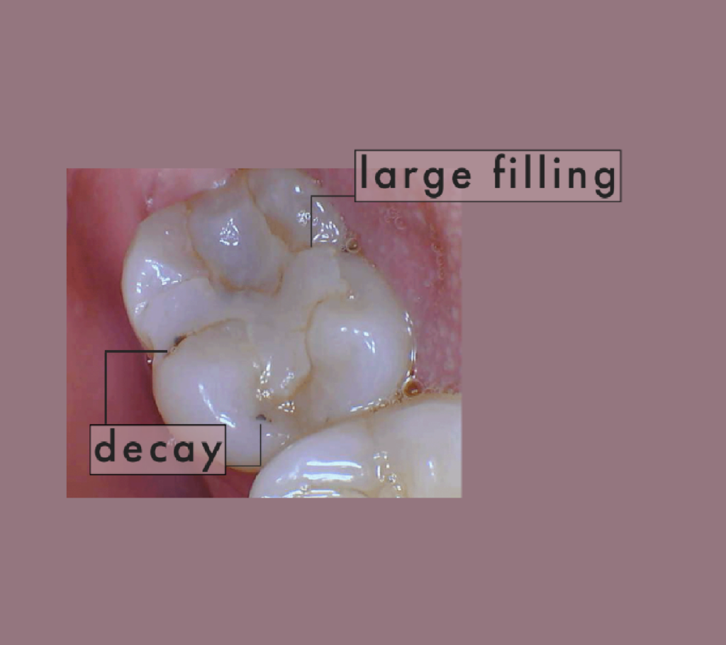 Dental Crowns in Fort Wayne, IN - Hale Family Dentistry